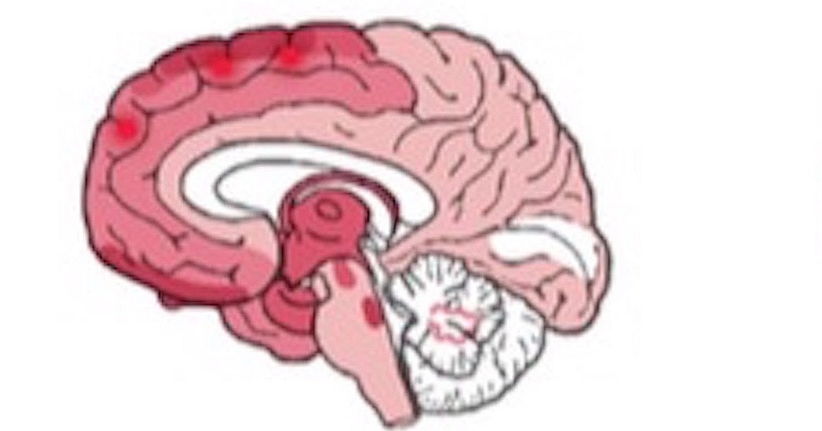 SportsBlog :: OlDocPushkin's Blog :: Kevin Turner and CTE: Now that we ...